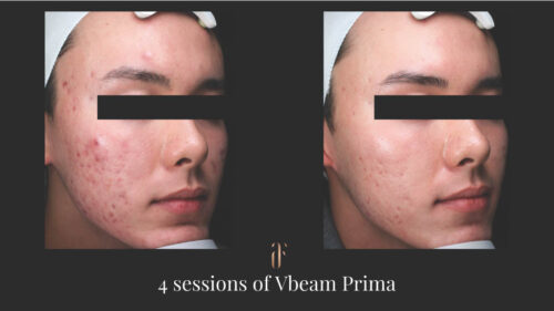 Vascular Treatment Sydney | Vein Treatment Chatswood | Vbeam Prima
