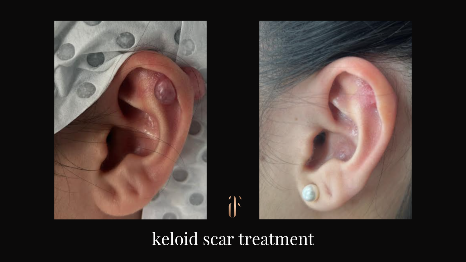 Keloid Scar Treatment Sydney | Keloid Treatment